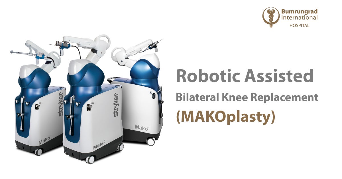 Bilateral Total Knee Replacement Surgery by MAKO Robotic